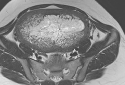 mricases: Endometrial Hyperplasia - MRI