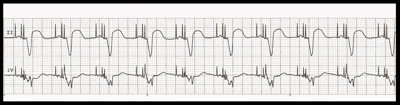 Practice EKG Strips 409