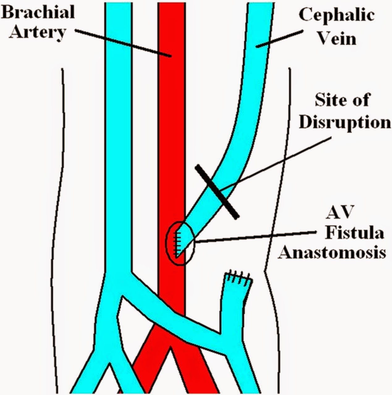 dokter wahyu spesialis bedah: cimino av shunt banjarmasin