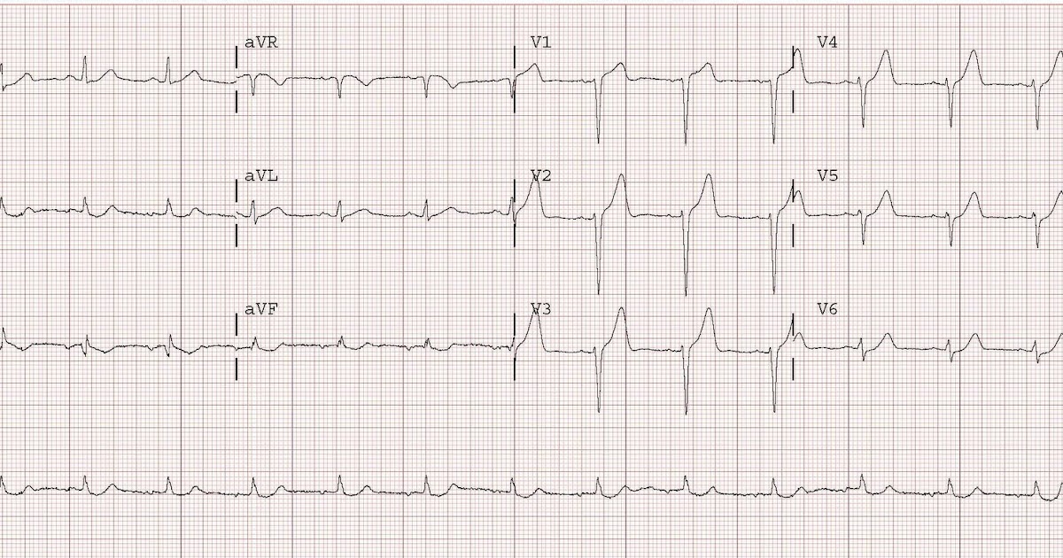 Dr. Smith's ECG Blog: Acute anterior STEMI from LAD occlusion, or ...