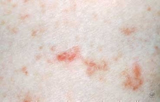 Asuhan Keperawatan Pasien Scabies Lengkap - askep