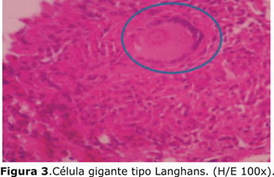 UNIDAD DE VOZ HOSPITAL DE PONIENTE: TUBERCULOSIS LARINGEA