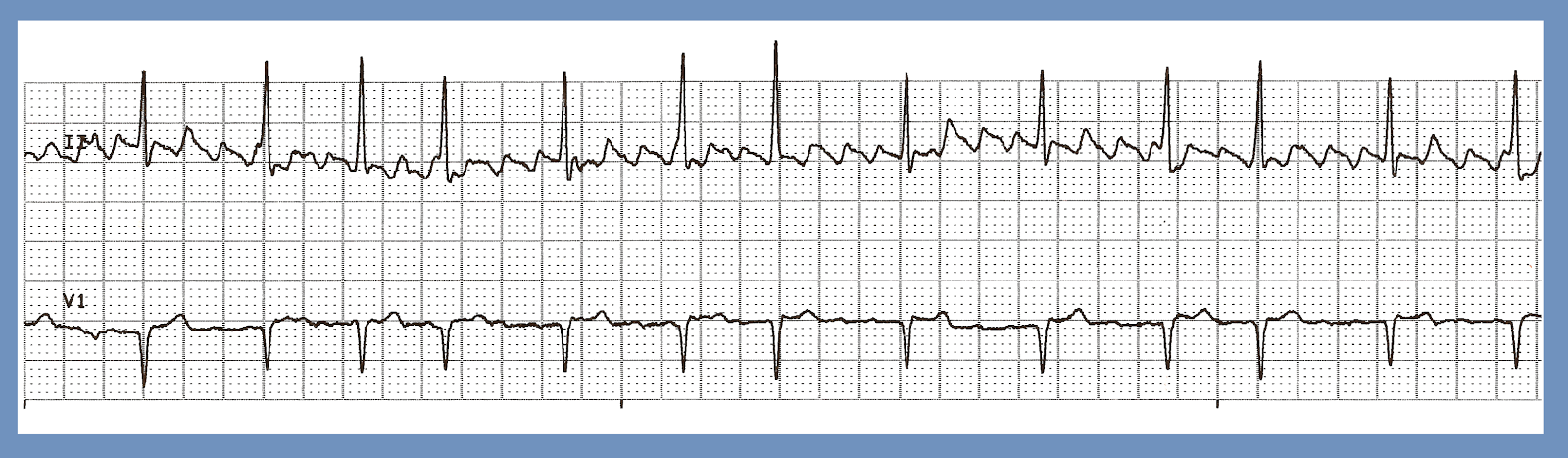 Float Nurse: Basic EKG Rhythm Test 22