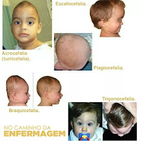 Todos Contra Arnold Chiari e Siringomielia: Tipos de malformação do crânio