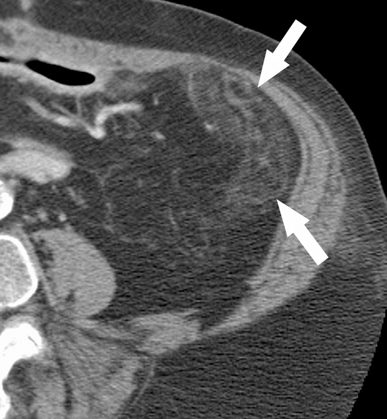 Omental Infarction Image Radiopaediaorg