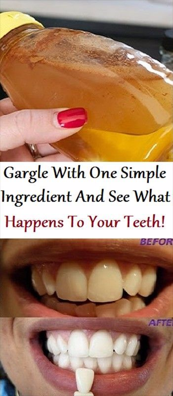 Gargle With One Simple Ingredient And See What Happens To Your Teeth ...