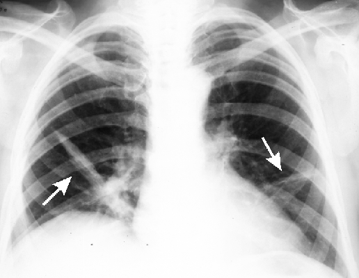 Respiratory Therapy Cave: Tips for reading chest x-rays