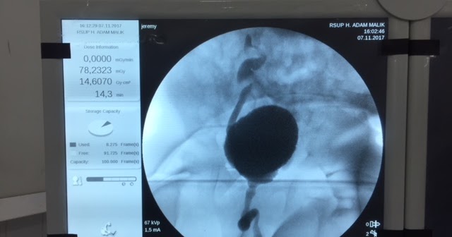VOIDING CYSTOURETHROGRAPHY (VCUG) | Sense Heal