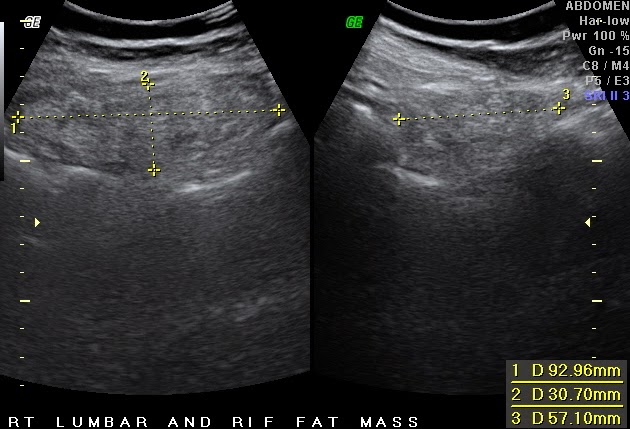 SONO DIGEST: OMENTAL INFARCT - ULTRSOUND EVALUATION