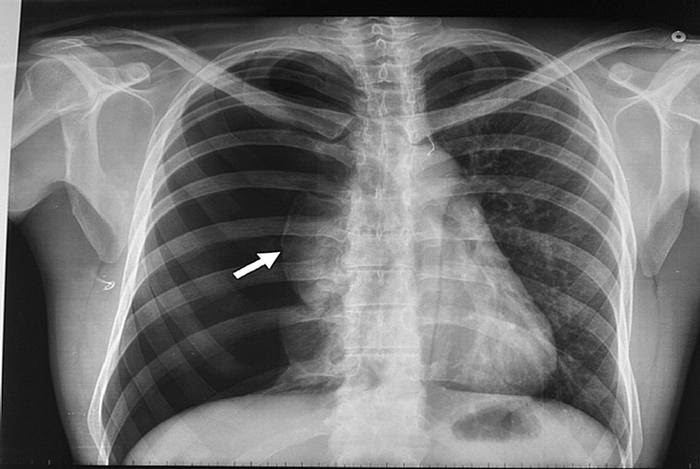 Neumotórax | Medicusmeo