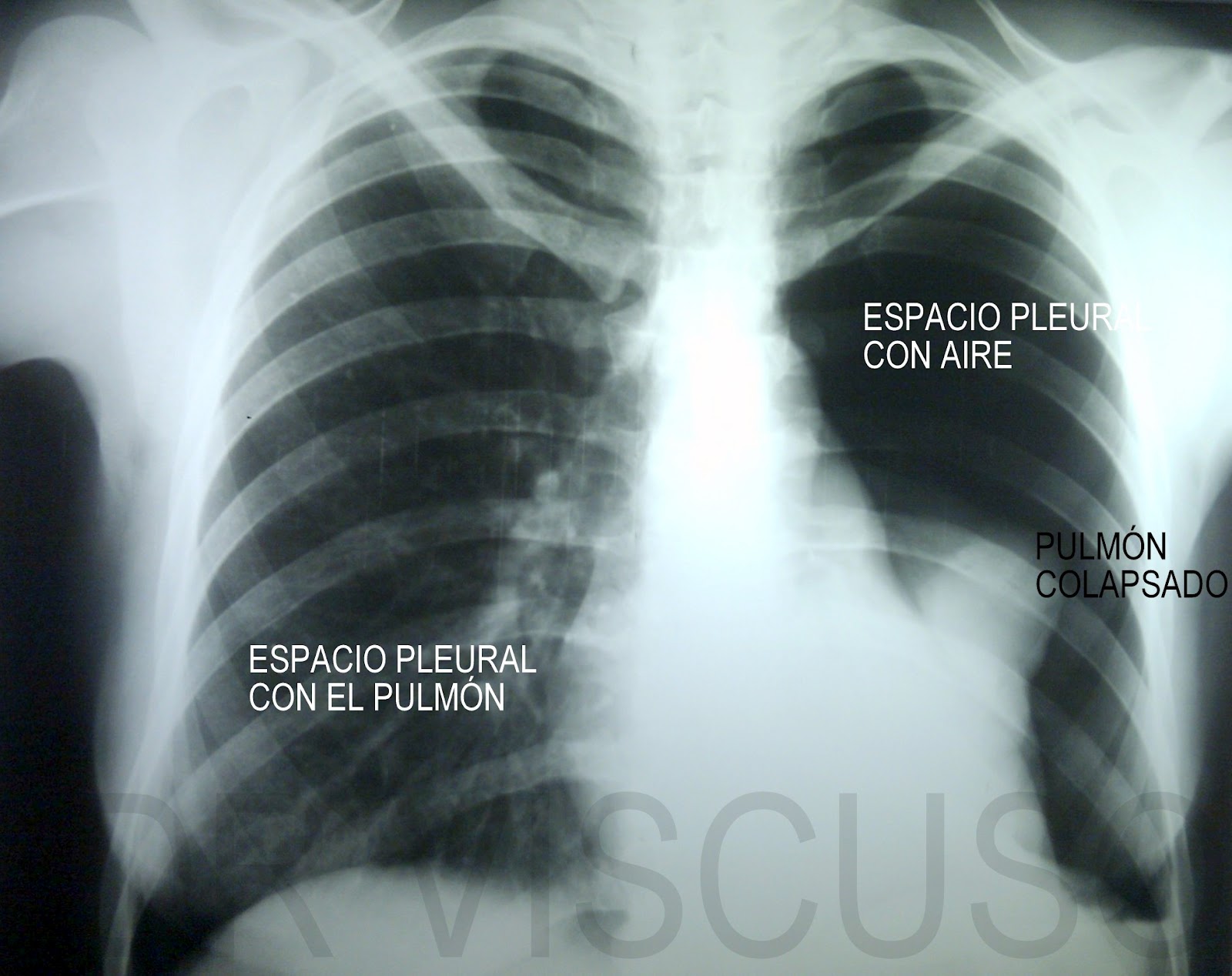 NEUMOTÓRAX A TENSION: ocurre