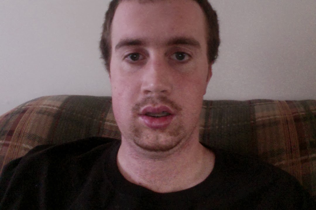 Double Jaw Surgery (Lefort I Advancement Bilateral BSSO (Bilateral ...