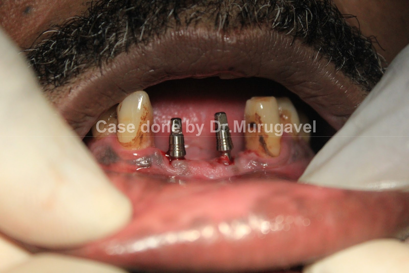 DR Murugavel's dental implant course: Replacement Of Missing Lower ...