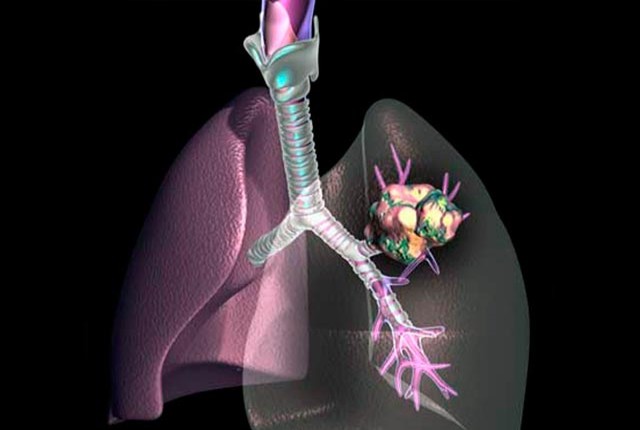 ΠΩΣ ΝΑ ΑΝΤΙΜΕΤΩΠΙΣΕΤΕ ΚΑΙ ΝΑ ΑΠΟΤΡΕΨΕΤΕ ΤΟΝ ΚΑΡΚΙΝΟ ΤΟΥ ΠΝΕΥΜΟΝΑ ΜΕ ...