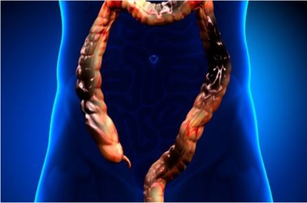 ASUHAN KEPERAWATAN PADA PASIEN KANKER KOLON / CA KOLON | Asuhan Perawat