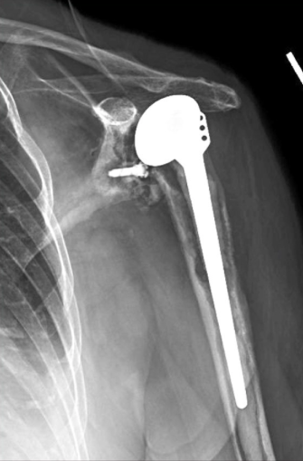 Shoulder Arthritis / Joint Replacement : Reverse total shoulder ...