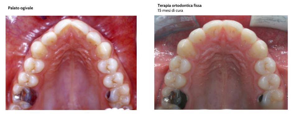 Studio Dentistico Balestro: Palato ogivale