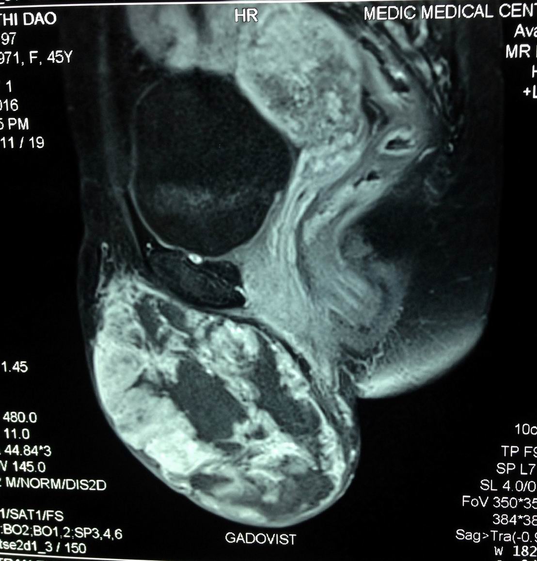 VIETNAMESE MEDIC ULTRASOUND: CASE 395: MAJOR LABIA TUMOR, Dr PHAN THANH ...