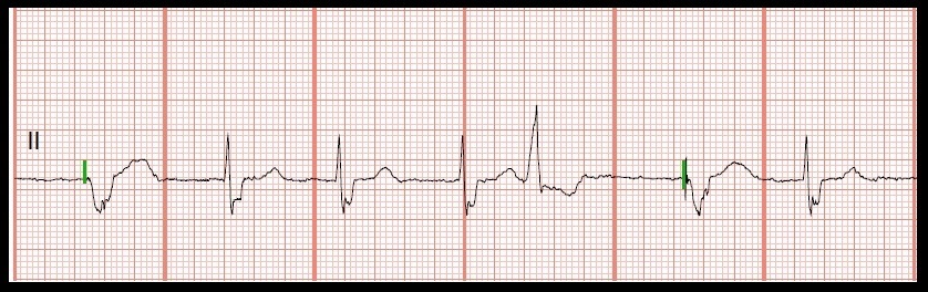 Practice EKG Rhythm Strips 189