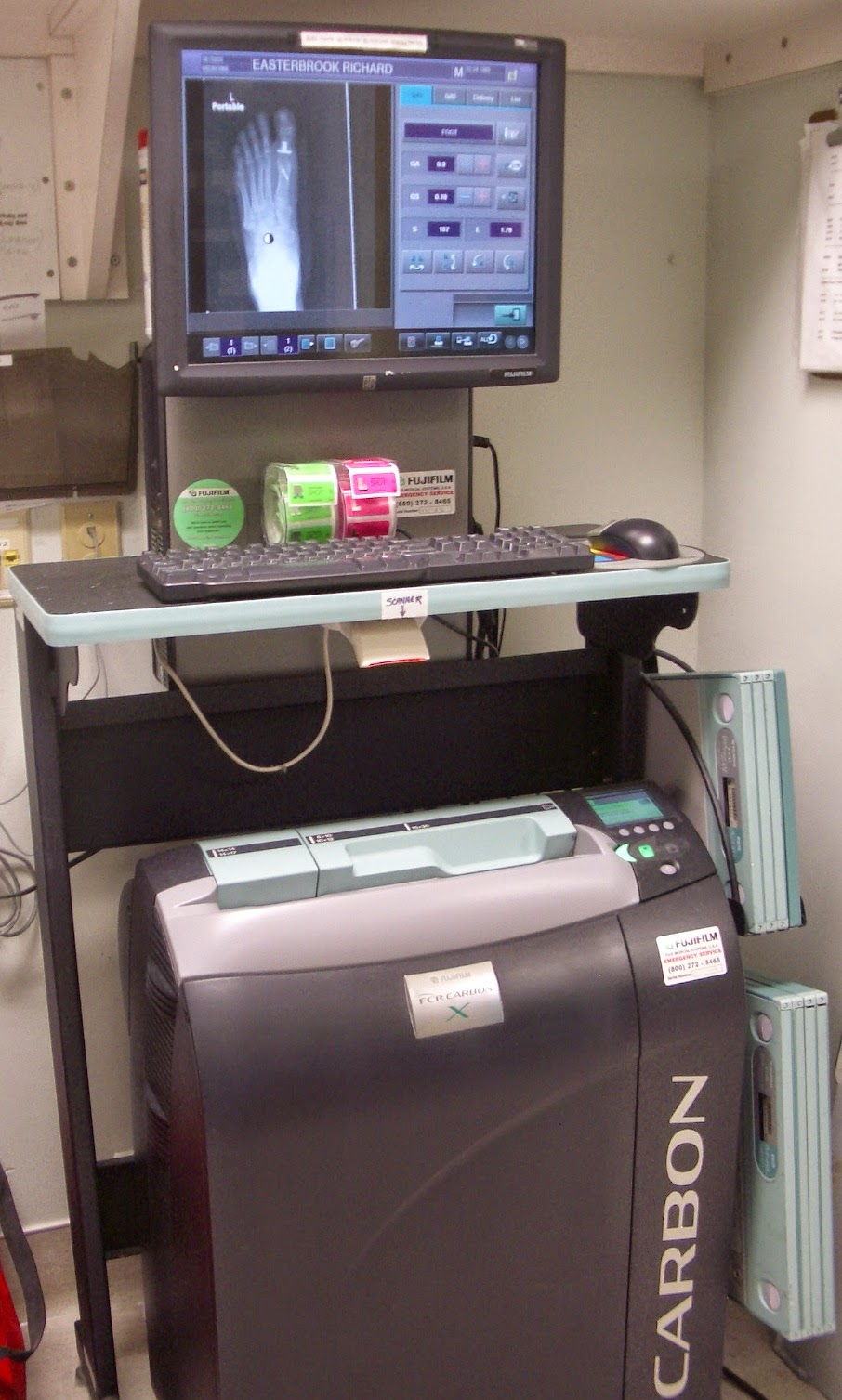 Podo Basas al Día: Operación de Hallux Límitus-Rígidus iatrogénico ...