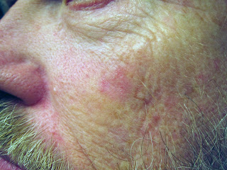 Efudex - Round Two: Day 4 - Starting to see some red areas