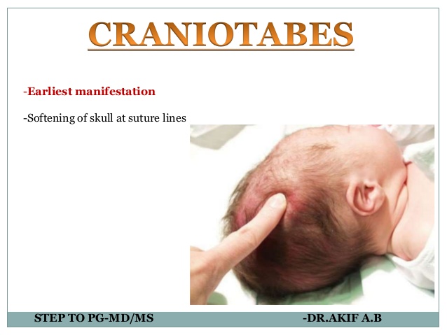 craniotabes - USA News Collections