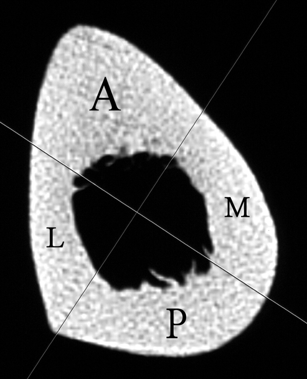 Injury Series: Tibial stress fractures and stress reactions: The role ...