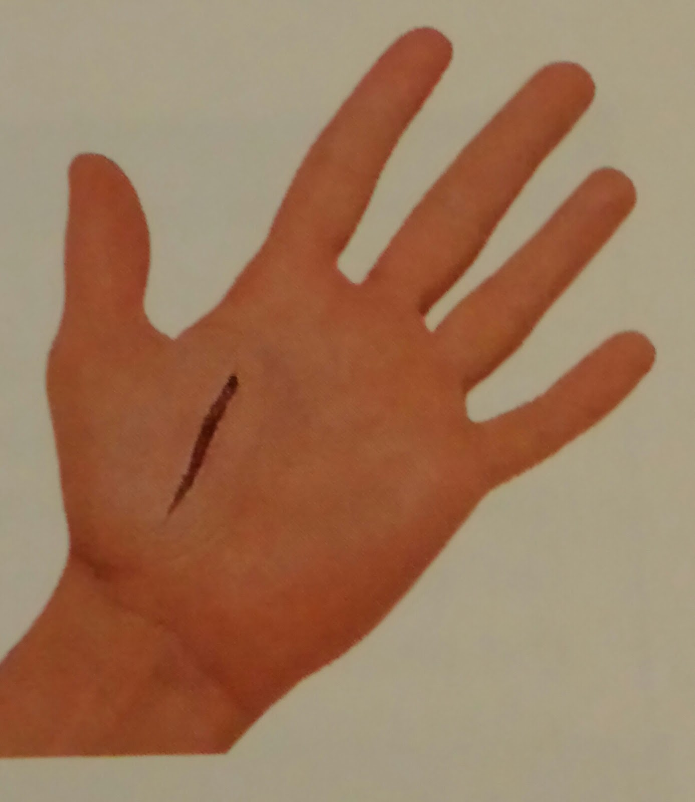 Keep Calm And Call A Paramedic: Management of Incised Wounds