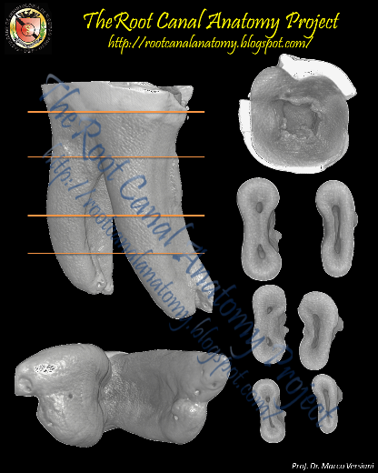 Root Canal Maxillary First Molar Anatomy