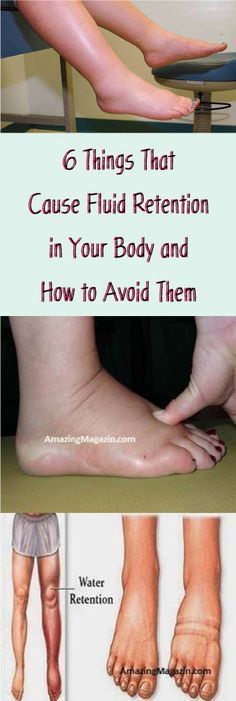 6 Things That Cause Fluid Retention in Your Body and How to Avoid Them ...