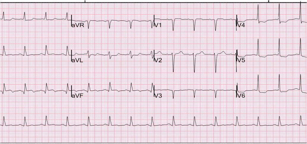 Dr. Smith's ECG Blog: Sudden Cardiogenic Shock