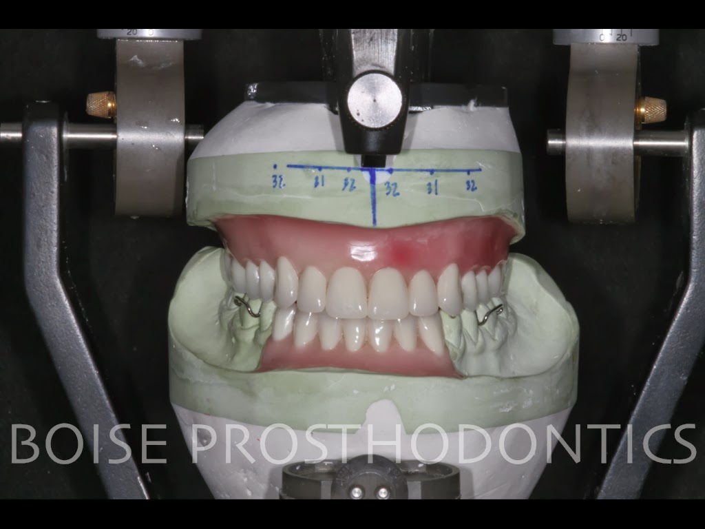 Boise Idaho Prosthodontics: True Immediate Maxillary Complete Denture ...