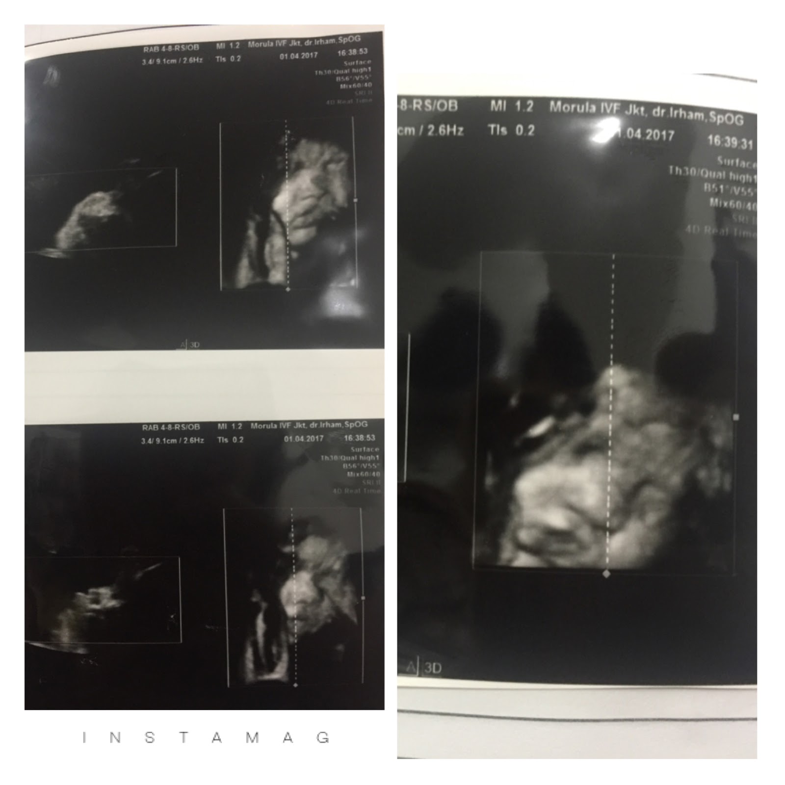 Berhasilnya penantian panjang melalui program bayi tabung (IVF): Jenis ...