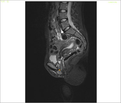 mricases: Episiotomy scar endometriosis