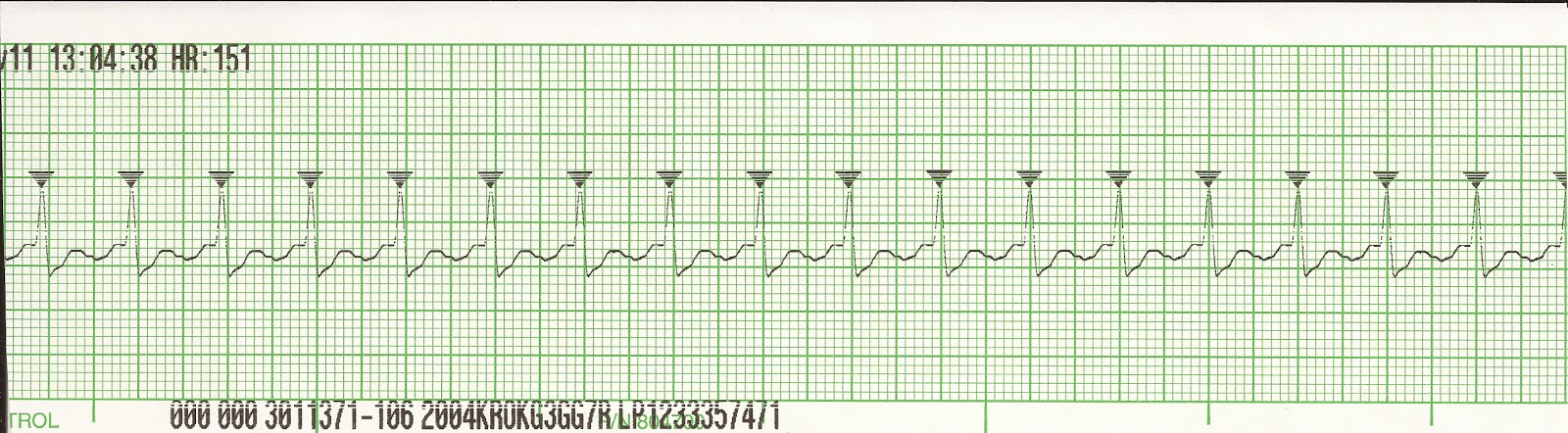 ACLS review: SVT part 7