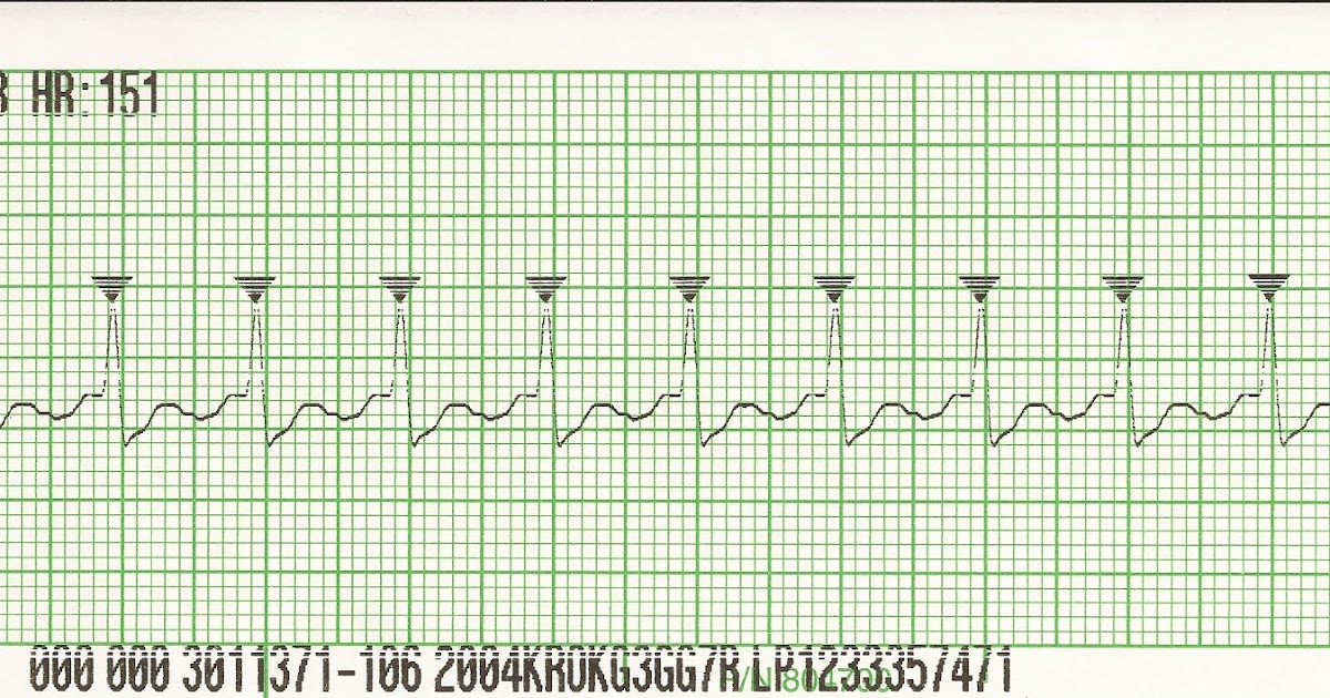 ACLS review: SVT part 7