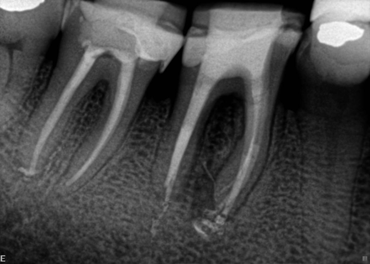 Patrick Baltieri: Dente 46 - EXODONTIA ou RETRATAMENTO?