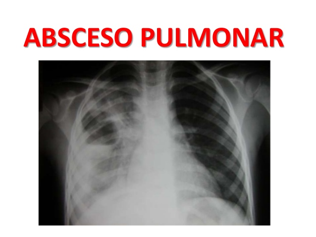 Filmarte MX: Absceso pulmonar.