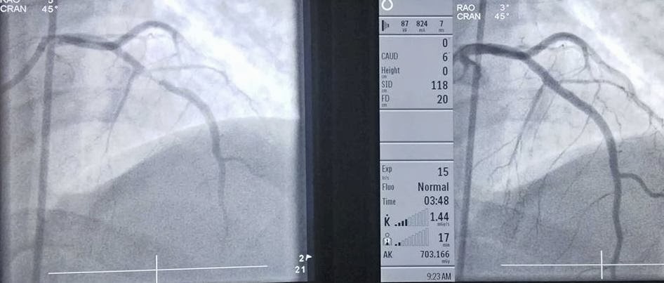 Primary Angioplasty-Cardiac Imaging - Sumer's Radiology Blog
