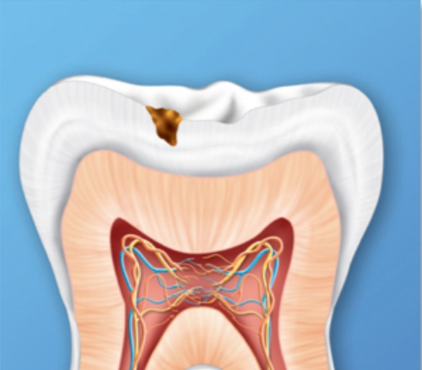 Odontólogos Landi-Maugeri: ¿Que son las caries?