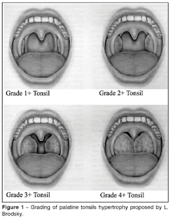 life according to us: Why do tonsils do that?
