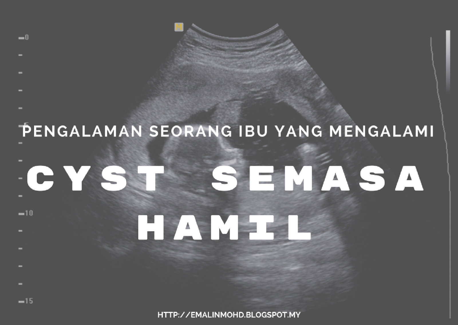 Pengalaman Ada Cyst Semasa Hamil - Healthy is a Lifestyle