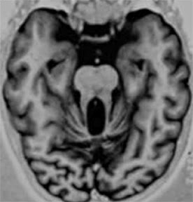 Case of the Day: Tooth in the Brain