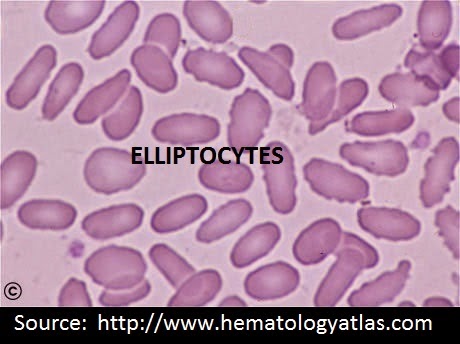 Lab Atlas: Elliptocytes