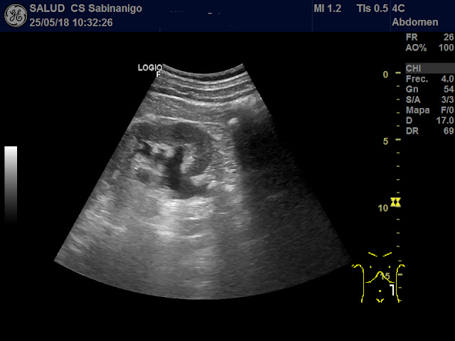 Ecografía en Atención Primaria: HIDRONEFROSIS POR LITIASIS