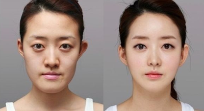 Asian Rhinoplasty Procedure | Korean Nose Job Experience | Kpop Plastic ...