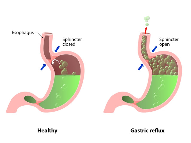 Acid Reflux | Symptoms | Treatment - By Dr. Arun Aggarwal