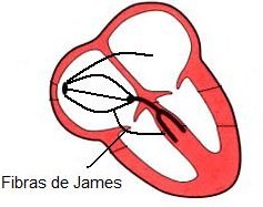 Cardiopneumologia: Suspeita de Síndrome Lown-Ganong-Levine (LGL)
