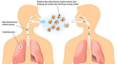 Cara Mencegah Penularan Penyakit Tuberkulosis (TBC) | Medkes