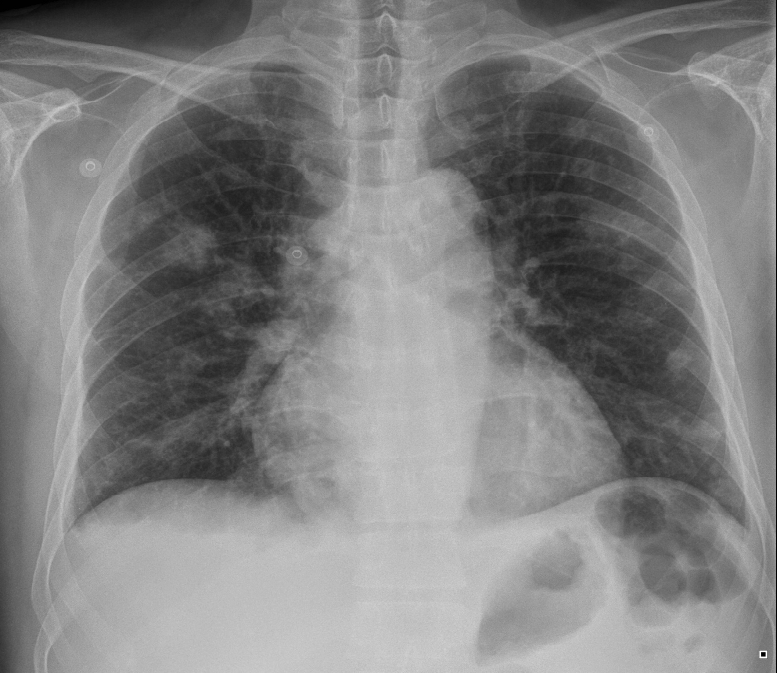 Casos de radiología de la Clínica Universidad de Navarra: CASO 215